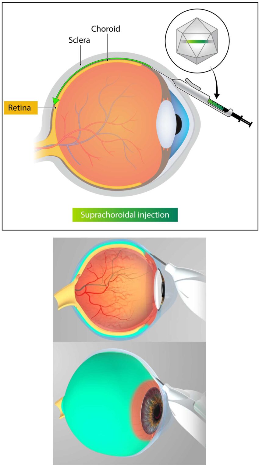 Opthalmology: Gene Therapy for Geographic Atrophy